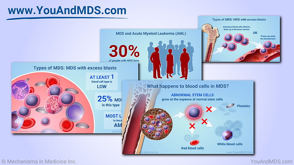 Expert Video - What is MDS-related anemia? What causes it?