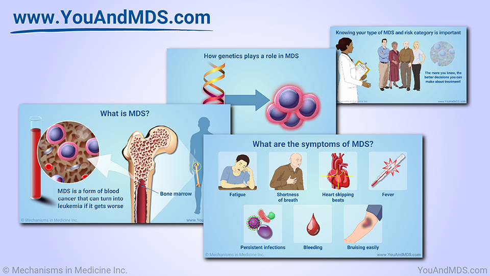 Slide Show - Understanding Myelodysplastic Syndromes